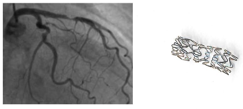 Infarkti i miokardit - Kerkimi Shkencor ne Infermieri - KSHI